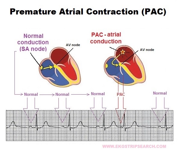 2 Atrial Foci AFL Af MAT 2-atrial-foci-afl-af-mat