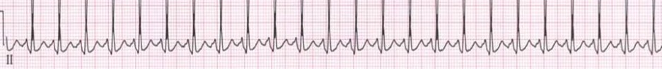 3 PSVT(Paroxysmal SupraVentricular Tachycardia) : 네이버 블로그