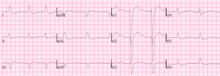 좌각차단(LBBB, Left bundle branch block) 심전도(ECG) 소견 : 네이버 블로그