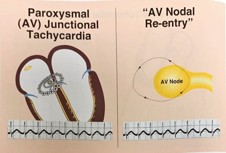3 PSVT(Paroxysmal SupraVentricular Tachycardia) : 네이버 블로그