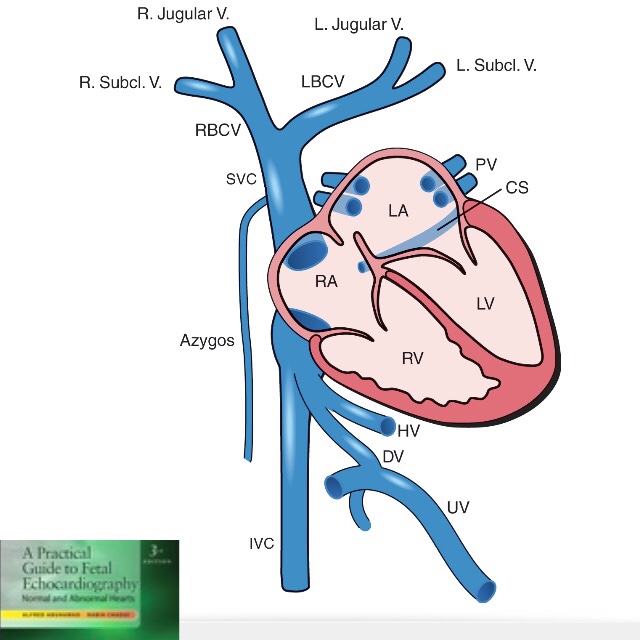 chap 31정리]Anomalies of Systemic and Pulmonary Venous Connection(LSVC ...