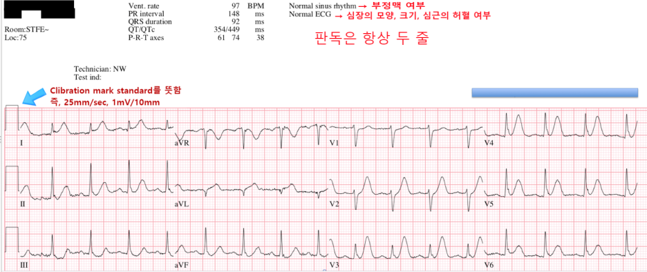 Step2. 12 lead EKG의 기본 : 네이버 블로그
