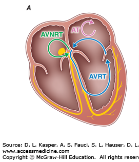 3 PSVT(Paroxysmal SupraVentricular Tachycardia) : 네이버 블로그