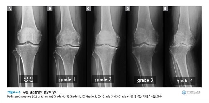[정형외과/OS] K-L grade / kellgren Lawrence 켈그렌 로렌스 분류법이란? : 네이버 블로그