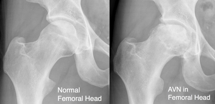 패트릭 테스트(patrick test) 방법 및 의미 : 네이버 블로그