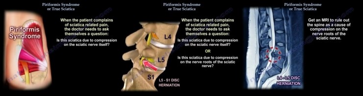 이상근 검사(FAIR test, piriformis test) 방법 및 의미 : 네이버 블로그