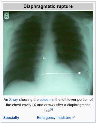 diaphragmatic rupture : 네이버 블로그