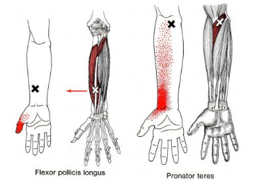 장무지굴근 통증유발점(Flexor Pollicis Longus Trigger Point Diagram) 엄지손가락 통증과 팔꿈치 ...
