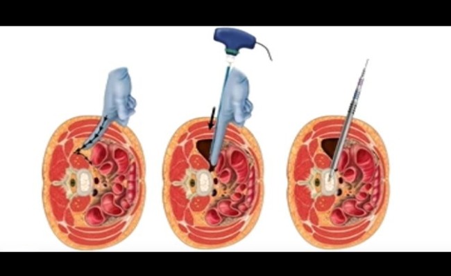 [참조은병원]척추관협착증 신개념 'OLIF수술' 도입 : 네이버 블로그