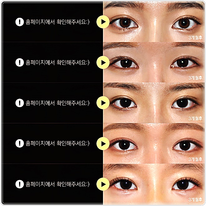 쌍수아웃라인 세미아웃라인까지 원하는 두께 조절 네이버 블로그