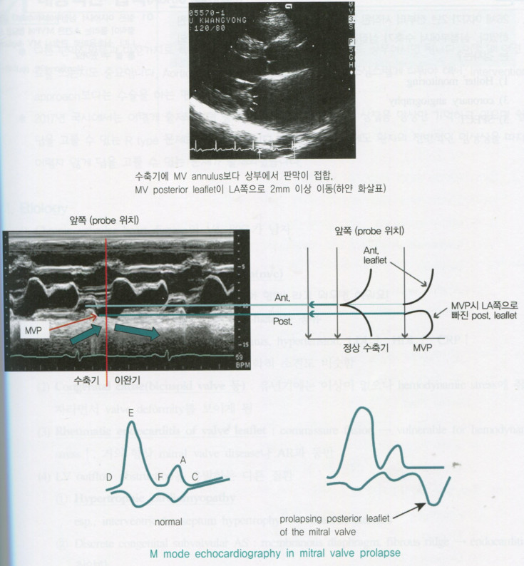 mitral valve prolapse (MVP, 승모판탈출) : 네이버 블로그