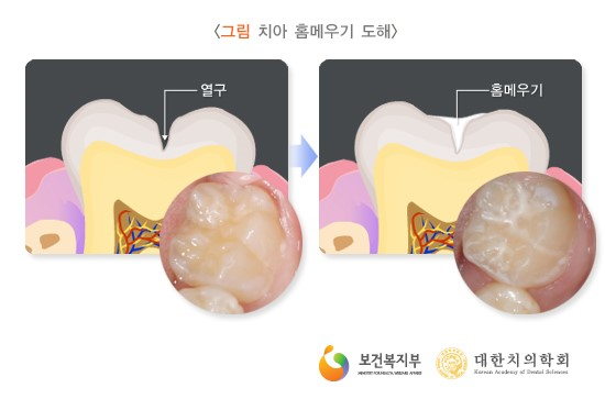 남양주어린이치과 치아홈메우기실란트 효과 보험적용 나이 가격은 네이버 블로그