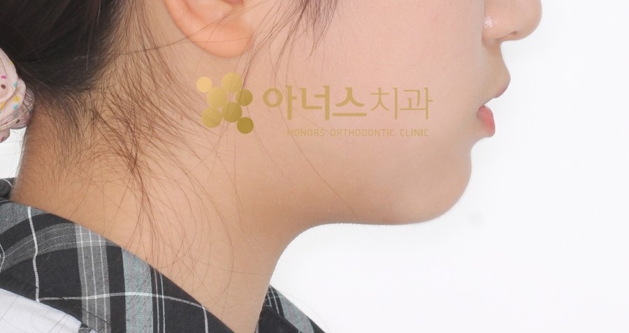남양주 교정치과에서 아래턱 돌출 개선을 위한 턱교정 치료 페이스마스크facemask와 Marpe 네이버 블로그