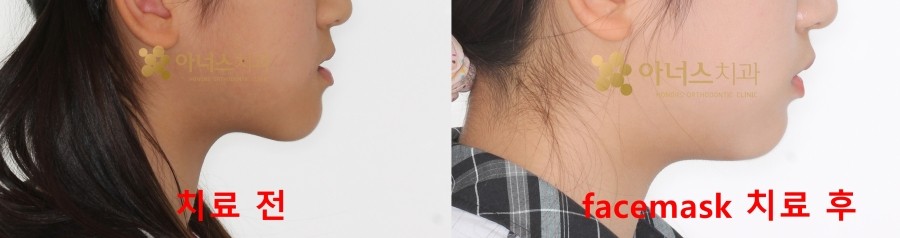 남양주 교정치과에서 아래턱 돌출 개선을 위한 턱교정 치료 페이스마스크facemask와 Marpe 네이버 블로그