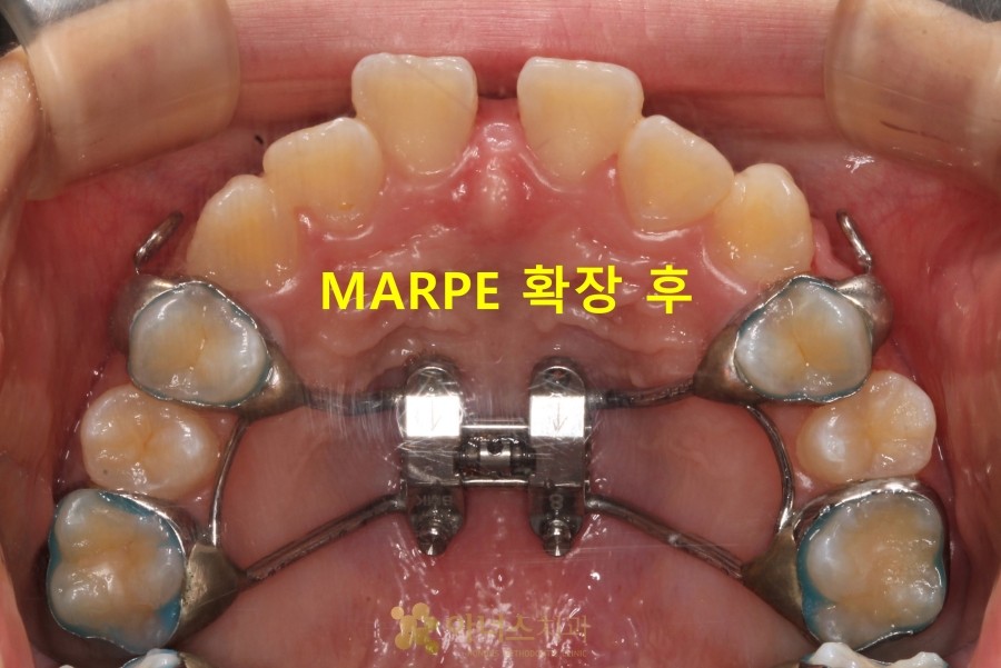 남양주 교정치과에서 아래턱 돌출 개선을 위한 턱교정 치료 페이스마스크facemask와 Marpe 네이버 블로그