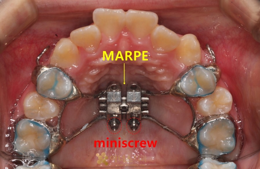 남양주 교정치과에서 아래턱 돌출 개선을 위한 턱교정 치료 - 페이스마스크(facemask)와 MARPE : 네이버 블로그