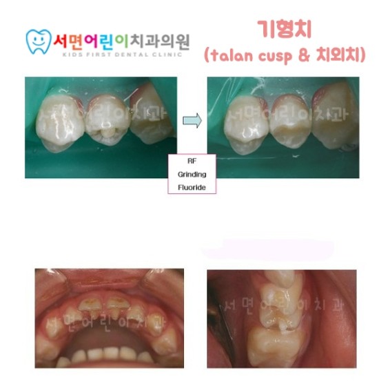 서면어린이치과 충치치료의 종류 3 기형치치외치 네이버 블로그