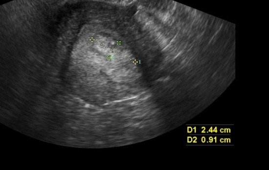 r/o EM polyp : 네이버 블로그