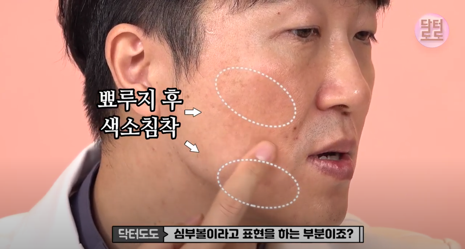 색소침착레이저시술 의료진이 직접 받아봤습니다 Feat 방식 기간 횟수 등이 고민인 분들을 위해 네이버 블로그
