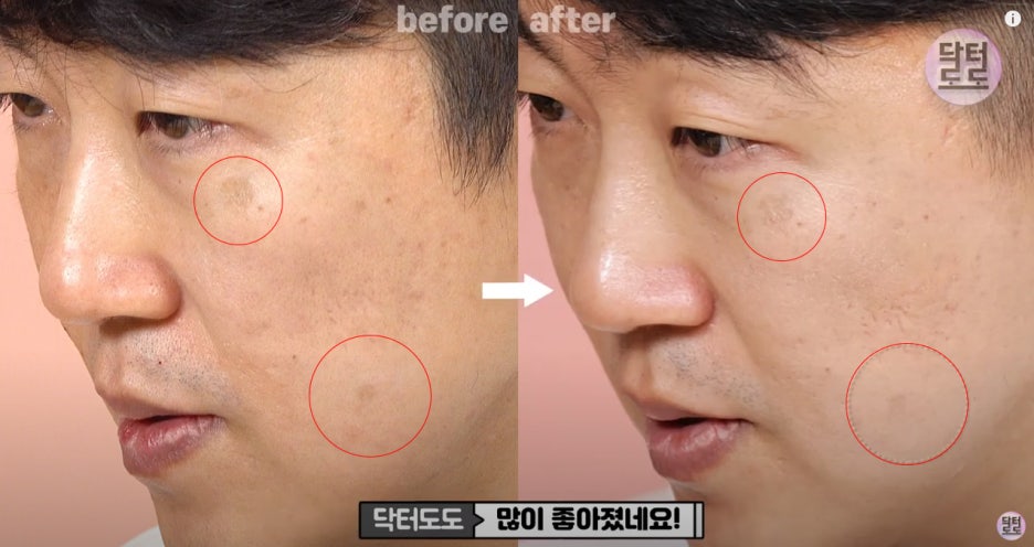 색소침착레이저시술 의료진이 직접 받아봤습니다 Feat 방식 기간 횟수 등이 고민인 분들을 위해 네이버 블로그