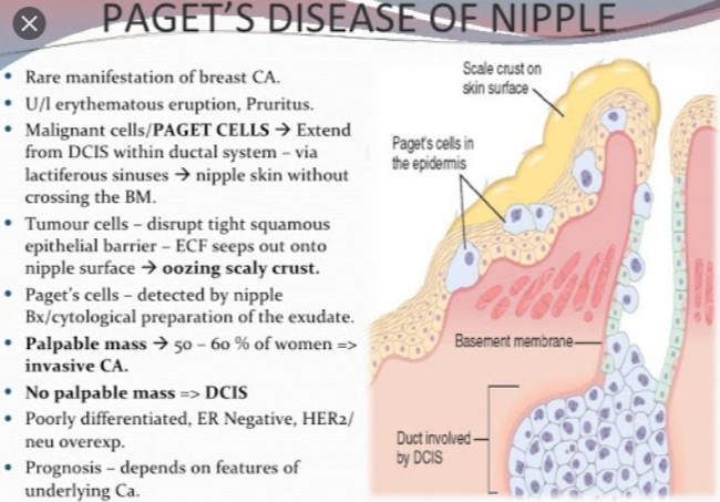 Paget's disease of the breast(유방의 파제트병) : 네이버 블로그