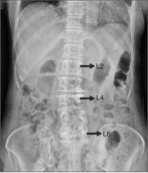 요천추 이행 척추 (Lumbosacral transitional vertebrae) - 요추 5번 천추화 ...