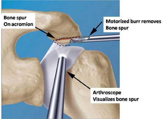 과연 어깨수술, 견봉돌기 성형술(Acromioplasty)은 회전근개파열에 최선일까? - 견봉돌기 모양에 따른 Type 분류 ...