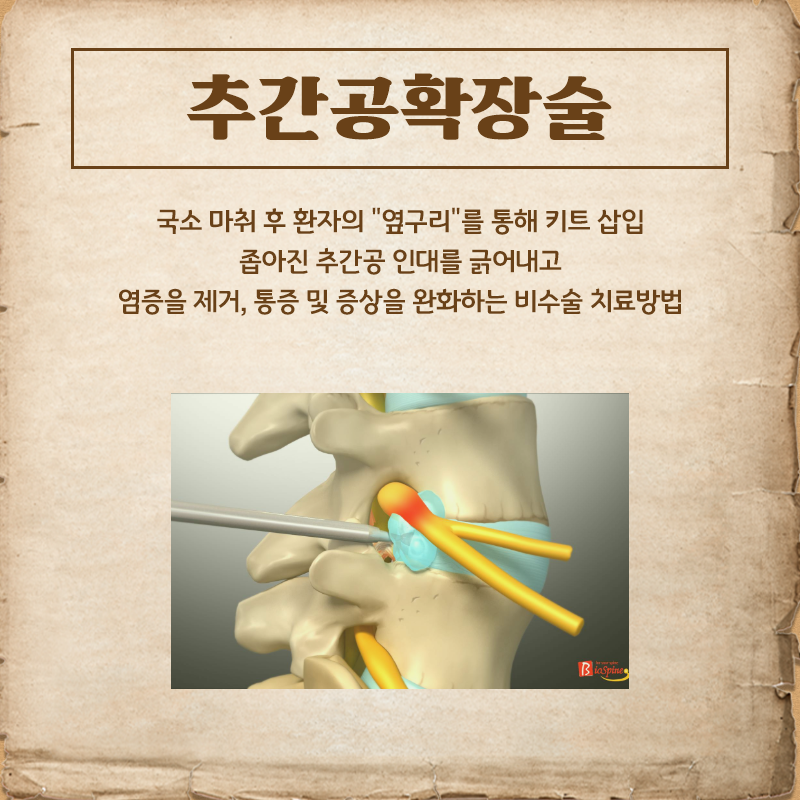 협착증치료명의 광혜병원의 추간공확장술 비용 네이버 블로그