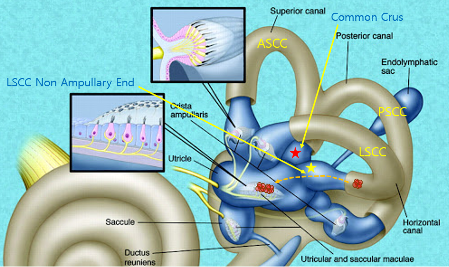 [BPPV] 수평세반고리관 관내결석증의 모든 것 7. LSCC Canalolithiasis의 정복술 이후 실시하는 Forced ...