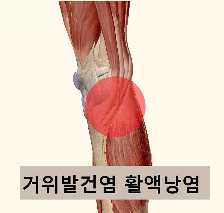 최소자극 도침 무릎안쪽 누를시 통증은 거위발건염 활액낭염을 의심 네이버 블로그