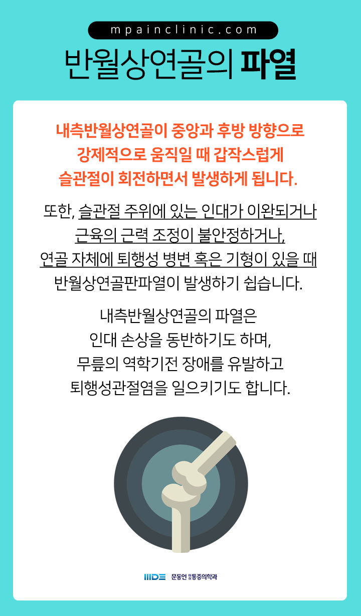 무릎연골찢어짐 시큰한 통증 무릎의 연골 파열 주의하세요 네이버 포스트