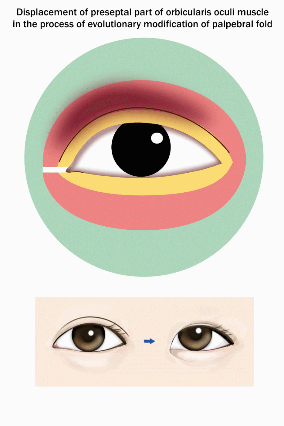 고식적 피부판 앞트임수술 방법들(methods of conventional skin flap epicanthoplasty) vs ...