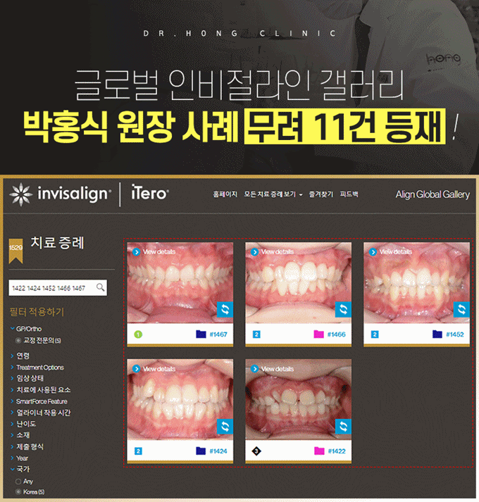 은평구치아교정 인비절라인 글로벌 갤러리에 11건 사례 등재 네이버 블로그
