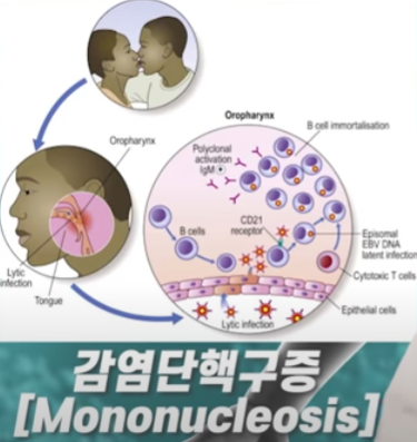 인후염 인후통 감염단핵구증(Mononucleosis)의 페니실린계 항생제(아목시실린) 전신발진 부작용의 금음체질 : 네이버 블로그