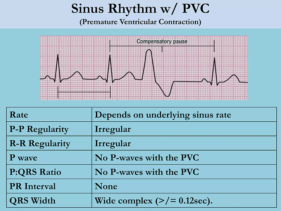 심실조기수축 심실조기박동 PVC VPC premature ventricular complex 심전도 증상 종류 원인 시술 치료 ...