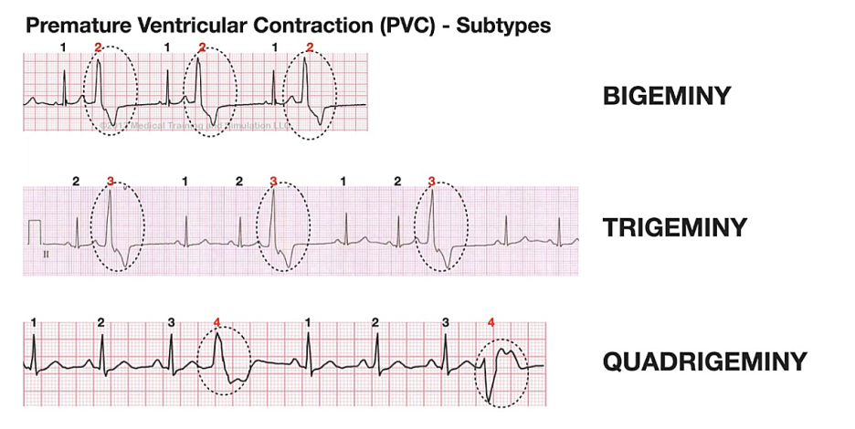 심실조기수축 심실조기박동 PVC VPC premature ventricular complex 심전도 증상 종류 원인 시술 치료 ...