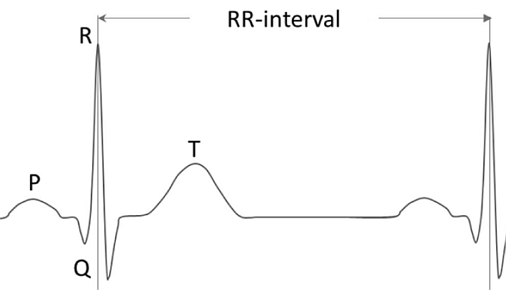 심실조기수축 심실조기박동 PVC VPC premature ventricular complex 심전도 증상 종류 원인 시술 치료 ...