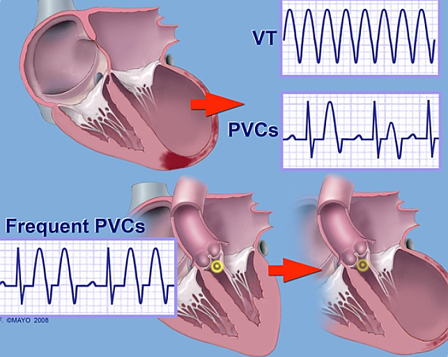 심실조기수축 심실조기박동 PVC VPC premature ventricular complex 심전도 증상 종류 원인 시술 치료 ...