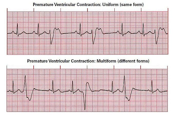 심실조기수축 심실조기박동 PVC VPC premature ventricular complex 심전도 증상 종류 원인 시술 치료 ...