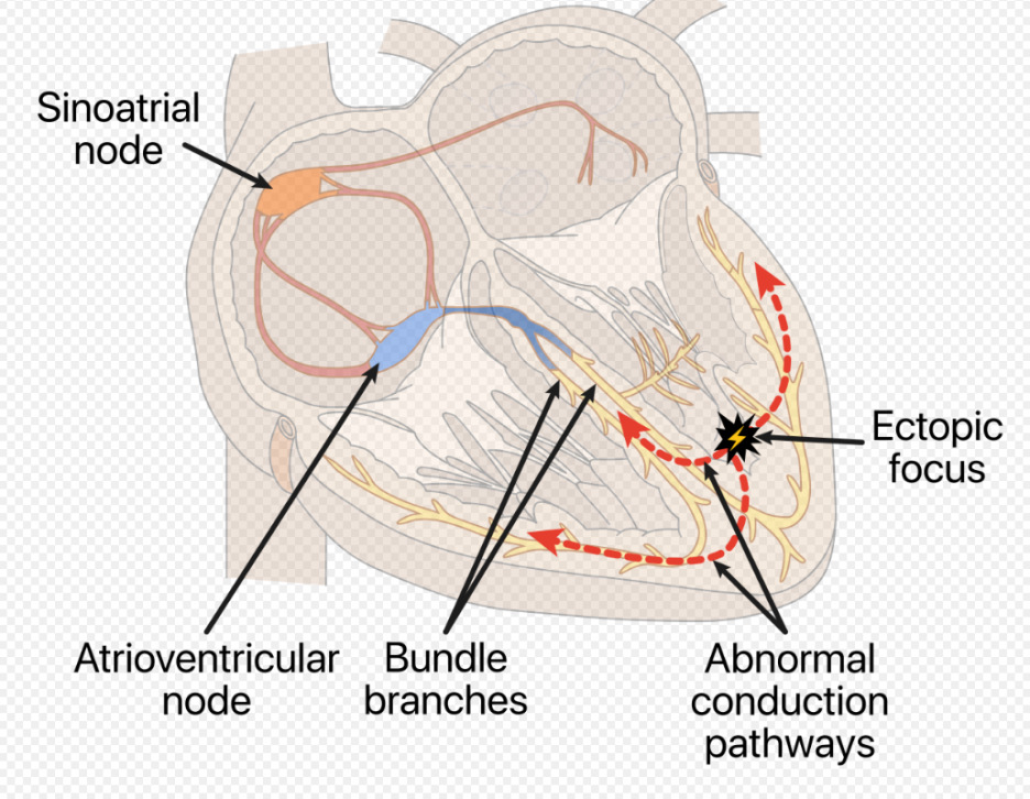 심실조기수축 심실조기박동 PVC VPC premature ventricular complex 심전도 증상 종류 원인 시술 치료 ...