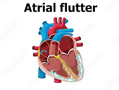심방조동 atrial flutter AFL 심전도 증상 치료 (+ 심방세동 atrial fibrillation AF 차이점 ...