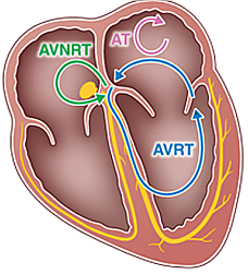 발작성상심실성빈맥 PSVT paroxysmal supraventricular tachycardia 특징 증상 심전도 치료 ...