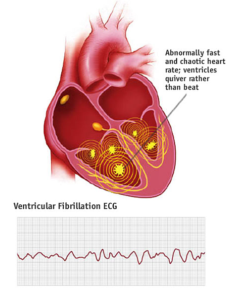 심실세동 VF Vfib ventricular fibrillation 정의 원인 심전도 증상 시술 치료 (+CPR ...