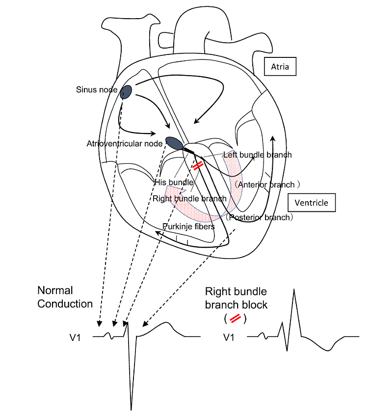 우각차단 RBBB right bundle branch block 원인 증상 심전도 EKG 특징 예후 치료 (+심장 자극전도계 ...