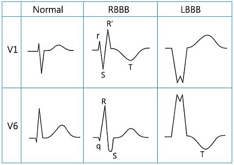 좌각차단 LBBB left bundle branch block 부정맥 원인 심전도 특징 증상 치료 (+우각차단 RBBB 차이점 ...
