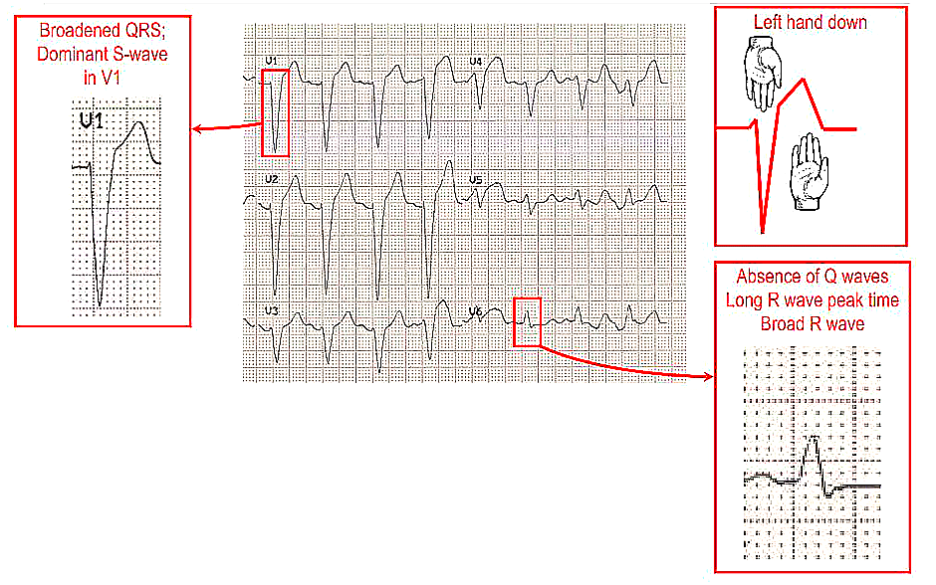 좌각차단 LBBB left bundle branch block 부정맥 원인 심전도 특징 증상 치료 (+우각차단 RBBB 차이점 ...