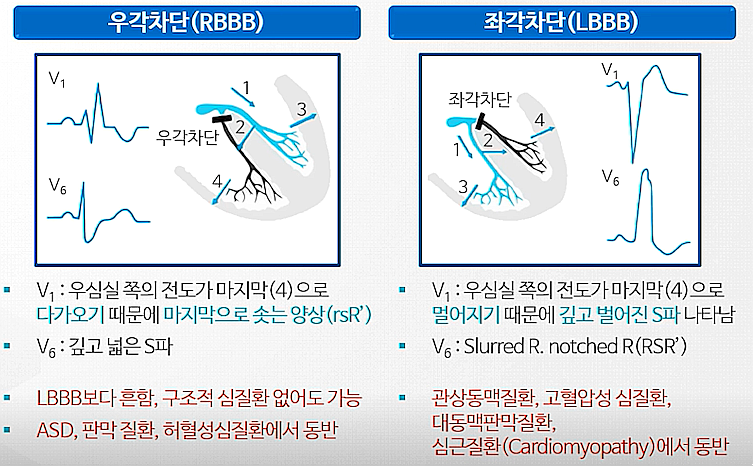 좌각차단 LBBB left bundle branch block 부정맥 원인 심전도 특징 증상 치료 (+우각차단 RBBB 차이점 ...