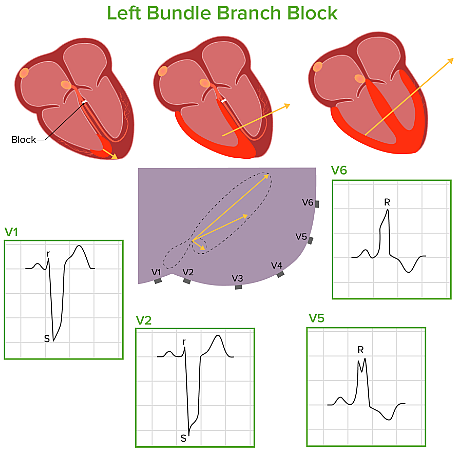 좌각차단 LBBB left bundle branch block 부정맥 원인 심전도 특징 증상 치료 (+우각차단 RBBB 차이점 ...