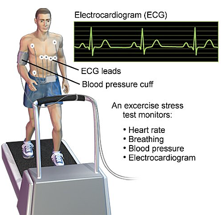 협심증 angina pectoris 증상 종류 심전도 치료 (+안정형 불안정형 이형성) (+CAG CABG PTCA PCI ...