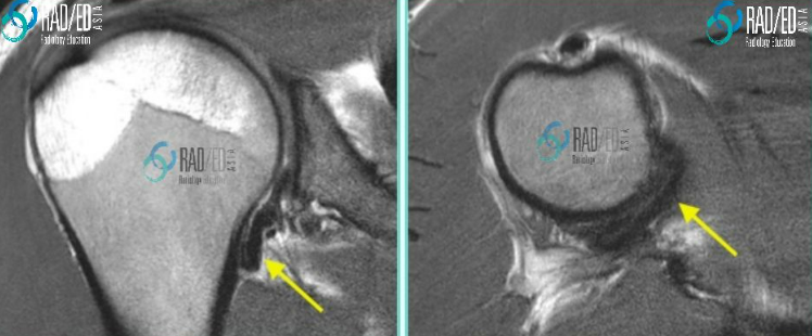 Frozen shoulder, adhesive capsulitis 진단 관련 내용 : 정상 어깨의 range of motion ...
